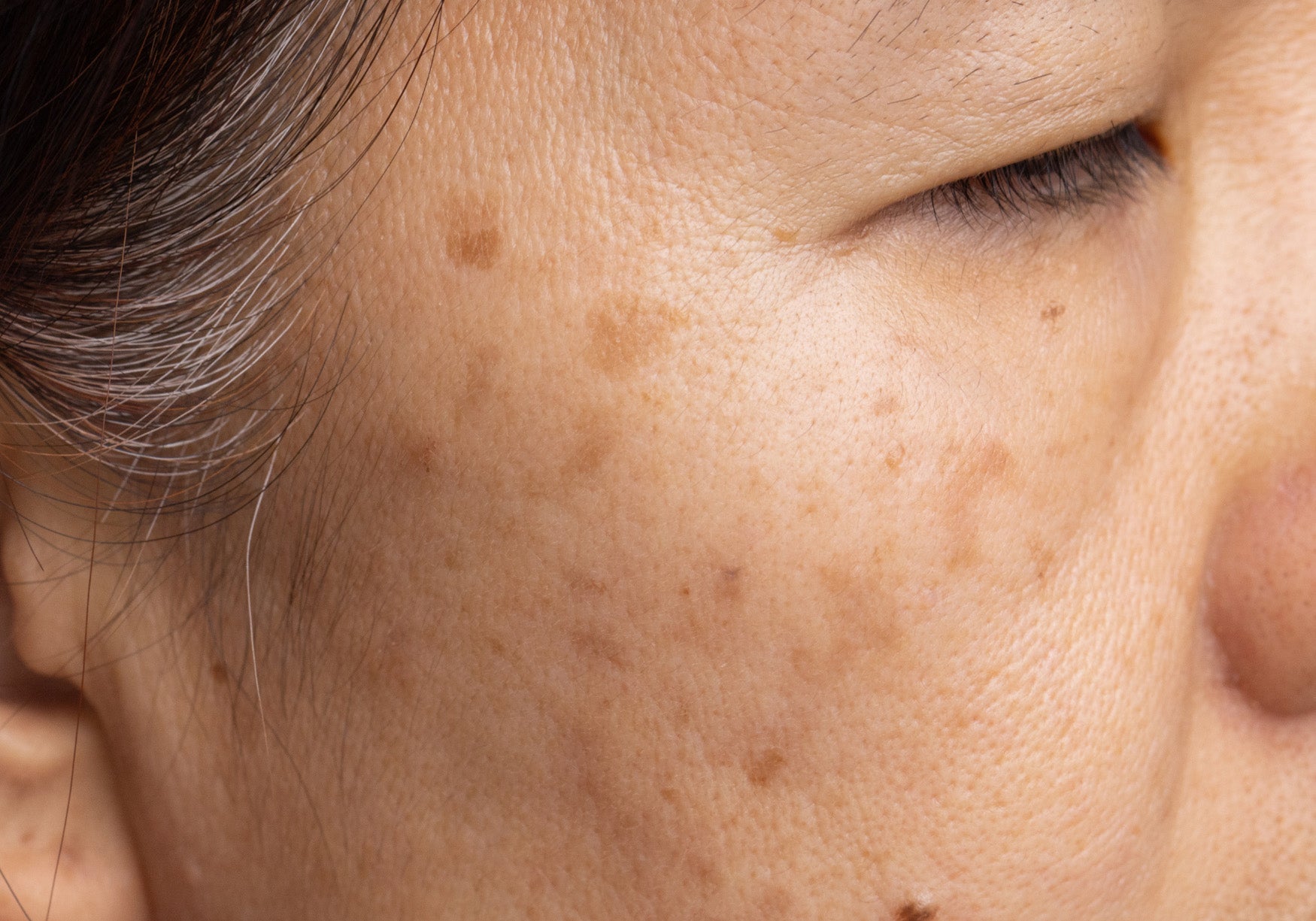 Understanding Skin Hyperpigmentation Causes And How To Treat – Fade Out ...